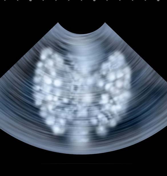 Thyroid Ultrasound | Endocrinologist in Forest Hills, Queens, NY ...