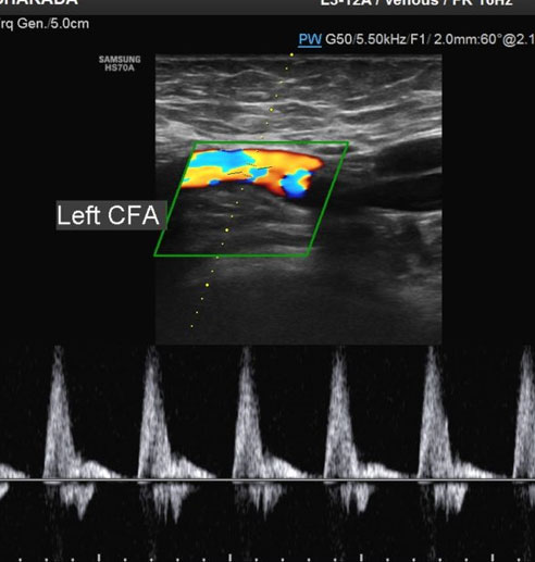 Venous Doppler | Cardiologists in Forest Hills, Queens, NY | Medex ...