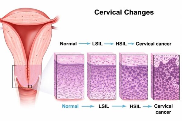 Epithelial Cell Abnormality: Causes, Risks & When to See a Doctor