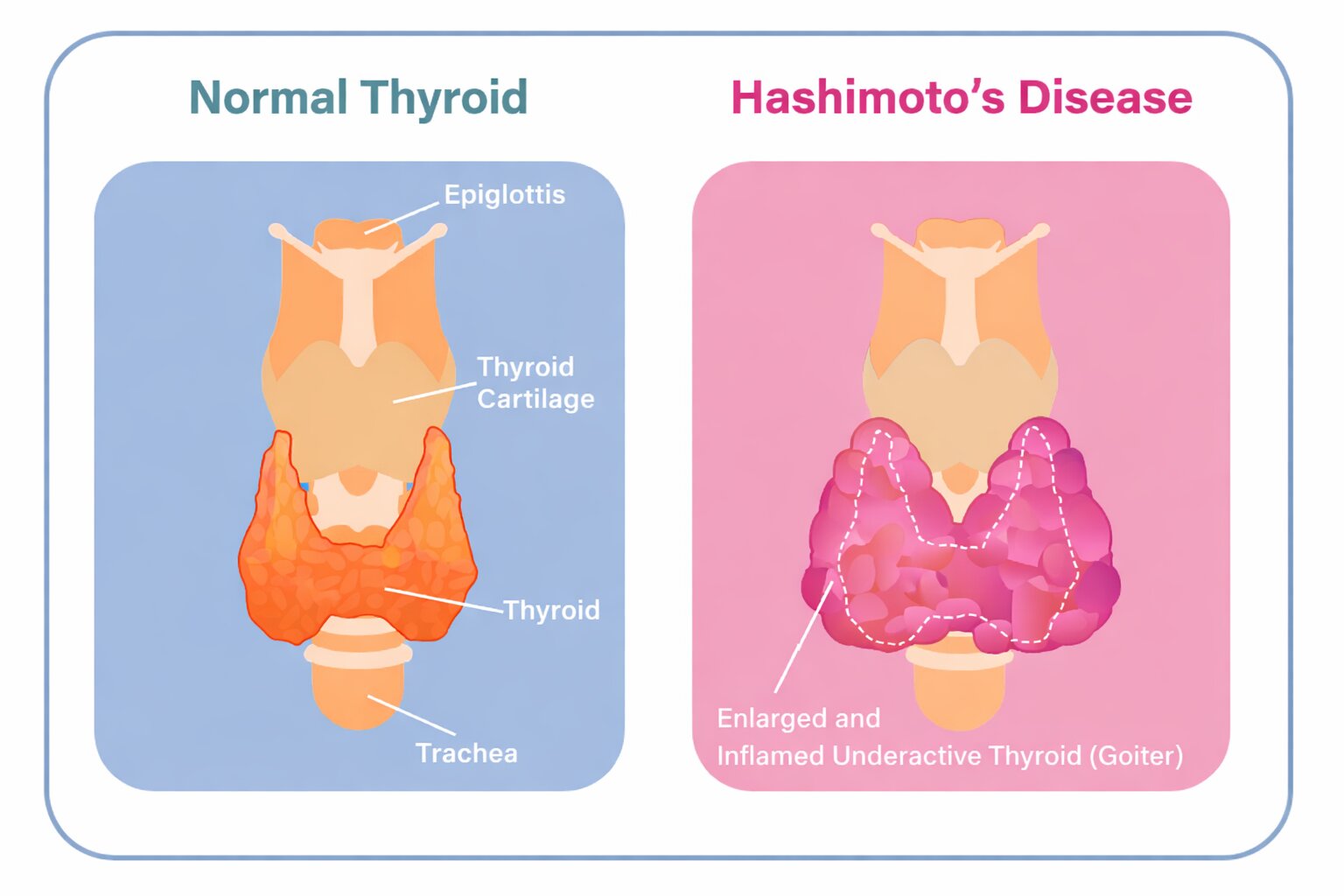 Enfermedad de Hashimoto (Tiroiditis de Hashimoto) - Medex DTC